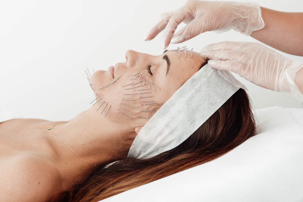 Nici autologiczne (needle shaping) – lifting bez skalpela i wypełniaczy ...