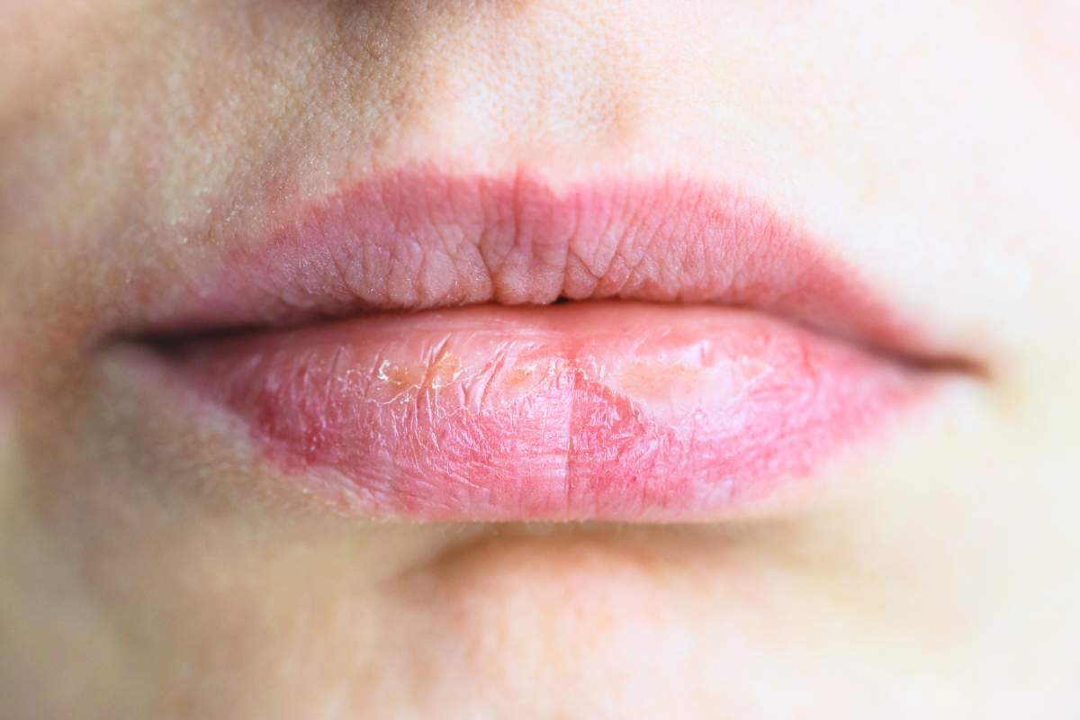 Co na suche, popękane usta? Moje najlepsze sposoby - Blog MJ